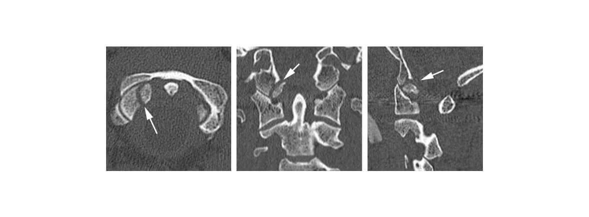Fractura de condilo occipital - Dr. Esteban Castro - Médico ...