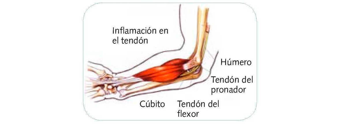 Epitrocleitis - Dr. Esteban Castro - Médico Traumatólogo Ortopédista ...