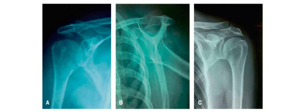 Lesión del manguito rotador - Dr. Esteban Castro - Médico Traumatólogo ...
