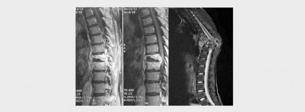 Mal de pott - Dr. Esteban Castro - Médico Traumatólogo Ortopédista ...