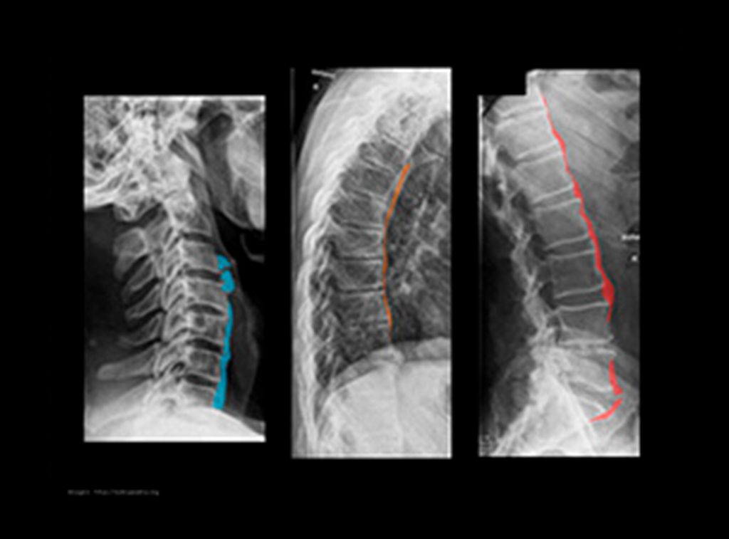 Cirugía de columna en guadalajara - Dr. Esteban Castro - Médico ...