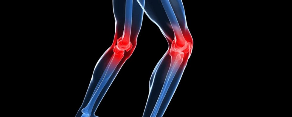 Todo lo que el paciente debe de saber sobre la condromalacia - Dr ...